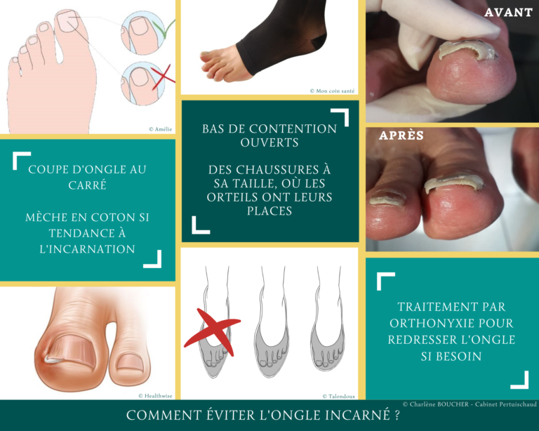 Ongle incarné : comment le prévenir et le soigner